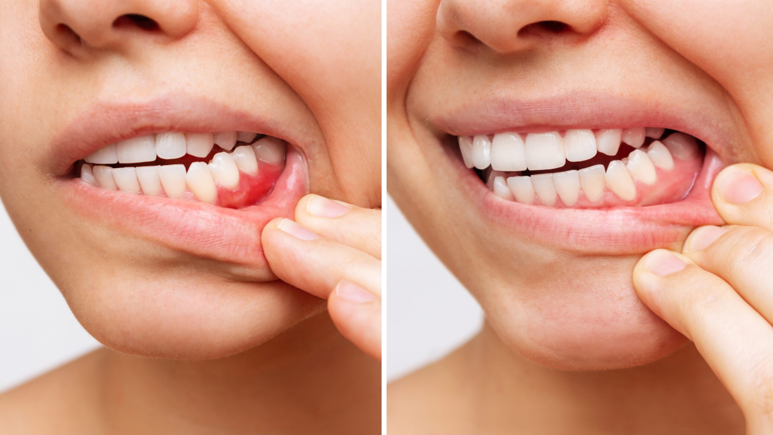 Recognize Gum Disease: Early Signs to Know in Bow, NH
